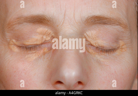 Tendon Xanthoma Hypercholesterolaemia Stock Photo Royalty