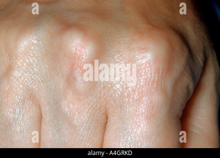 Tendon Xanthoma Hypercholesterolaemia Stock Photo Royalty