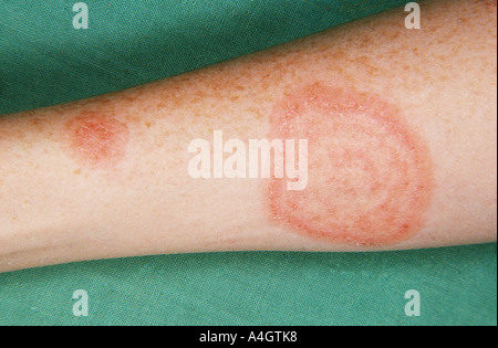 ringworm fungus infection of the skin Stock Photo - Alamy