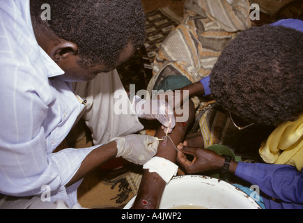 Dracunculus medinensis, Guinea Worm Extraction Stock Photo - Alamy