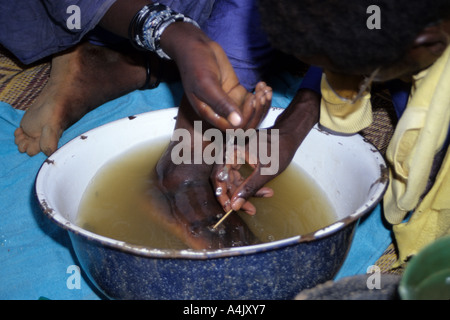 Dracunculus medinensis, Guinea Worm Extraction Stock Photo - Alamy