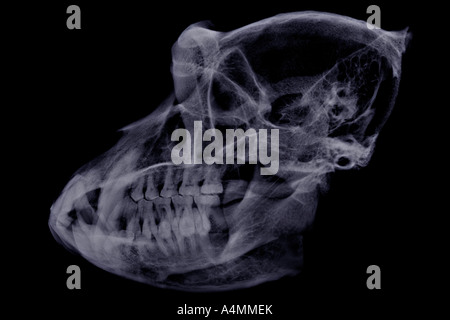 X-ray of the mandible and denture Stock Photo - Alamy