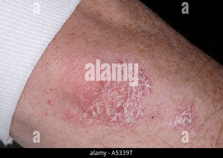 Plaque psoriasis close-up on leg Stock Photo: 11180962 - Alamy