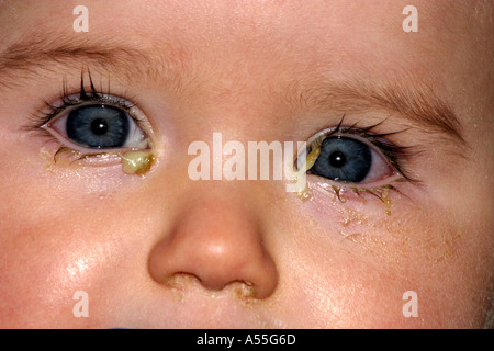 Baby suffering from conjunctivitis infection of the eye Stock Photo - Alamy