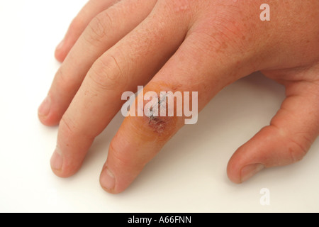 CLOSE UP OF A BROKEN CUT KNUCKLE ON A RIGHT HAND WITH STITCHES WHITE ...