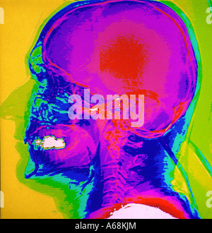 Color CAT scan of the lateral skull Stock Photo - Alamy