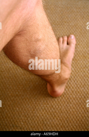 Leg with varicose veins close up Standing person with varicose veins in ...