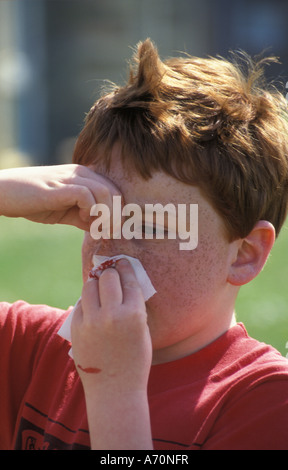 CHILD WITH NOSEBLEED Stock Photo - Alamy