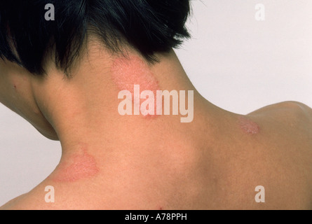 LICHEN SIMPLEX CHRONICUS Stock Photo - Alamy