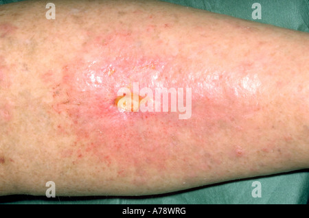 RADIOTHERAPY ULCER ON LEG Stock Photo - Alamy