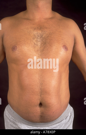 A photograph of a male with HIV associated lipodystrophy syndrome Stock ...