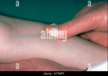 The Heaf test is a skin test performed in order to determine whether ...
