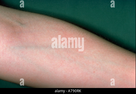 TUBERCULIN SKIN TEST Stock Photo - Alamy