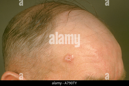 basal cell carcinoma - rodent ulcer- on the cheek. Also shown is Stock ...