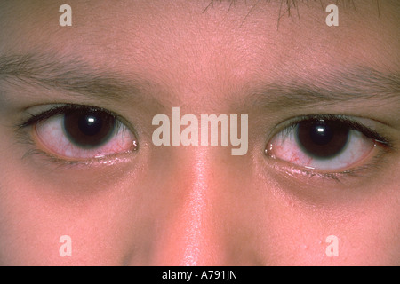 Eye of a child with conjunctivitis, inflammation of the conjunctiva ...