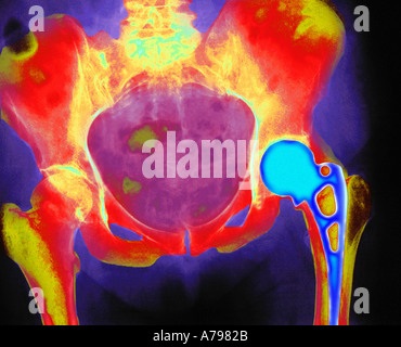 Hip joint replacement. Coloured X-ray of the pelvis (front view) of a ...