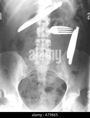 X ray swallowed foreign bodies Stock Photo - Alamy