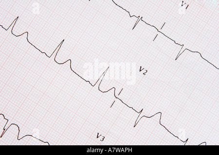 ECG (electrocardiogram) heart trace showing the irregular heartbeat of ...