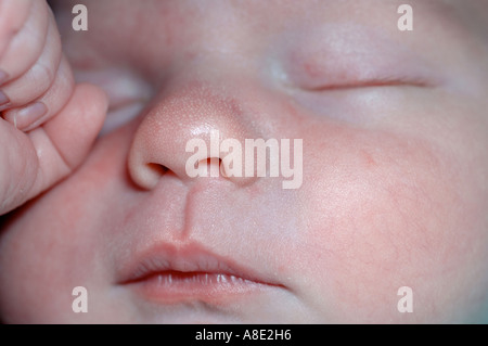 Milk spots or milia on baby's nose Stock Photo - Alamy