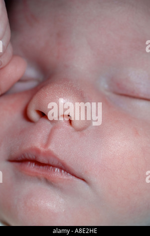 Milk spots or milia on baby's nose Stock Photo - Alamy