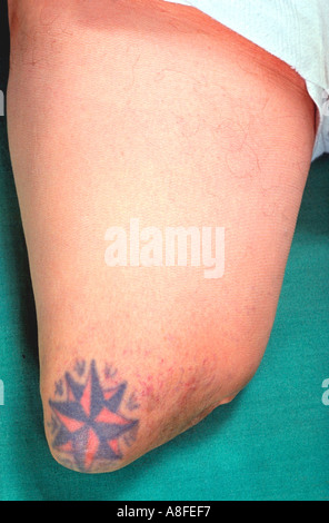 healed amputation stump Stock Photo - Alamy