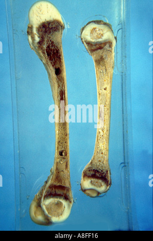 Rickets Femur Tibia Stock Photo - Alamy