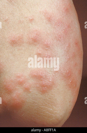 A photograph of erythema multiforme Stock Photo - Alamy