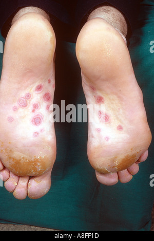 A photograph of erythema multiforme Stock Photo - Alamy