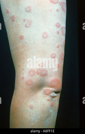 A photograph of erythema multiforme Stock Photo - Alamy