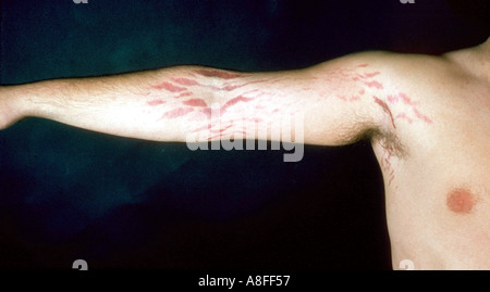 Cushings syndrome - striae Stock Photo - Alamy
