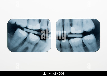 Dental xray x-ray film showing rows of traditional amalgam fillings and ...