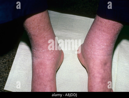 Seborrheic keratosis benign skin tumor. Harmless unsightly skin ...