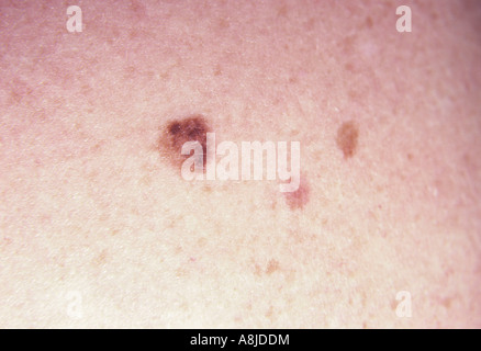 Seborrheic keratosis, benign tumor. Is a very common tumor. Also known ...
