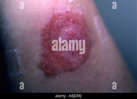 HERPES SIMPLEX VIRUS Stock Photo - Alamy