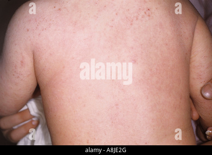 Child's back. Eczema atopic dermatitis symptom skin. Symptom Stock ...