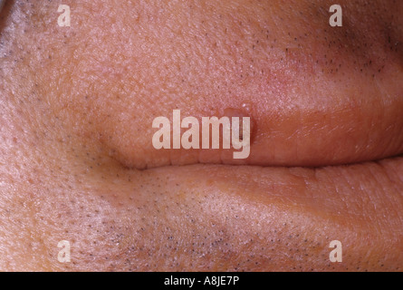 Common wart caused by HPV, Human Papilloma Virus Stock Photo - Alamy