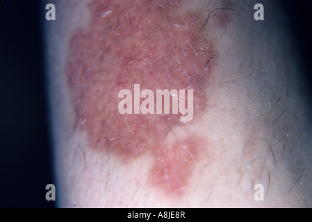 Necrobiosis Lipoidica Diabeticorum (NDL) is a rash which usually occurs ...