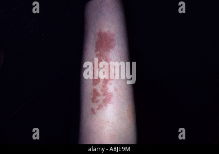 Necrobiosis lipoidica diabeticorum is a rash which usually occurs on ...