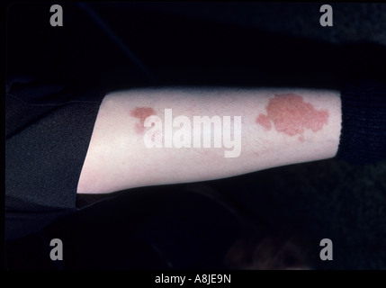 Necrobiosis lipoidica diabeticorum is a rash which usually occurs on ...