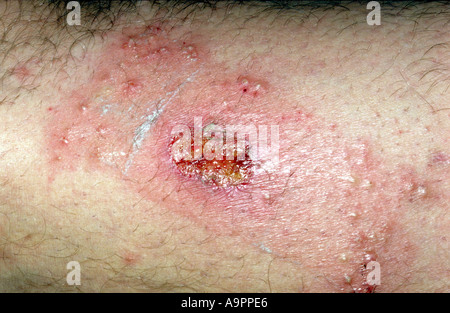 Cutaneous leishmaniasis: skin lesion Stock Photo - Alamy