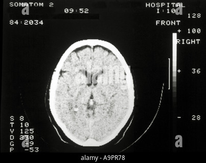 normal CT scan of brain (Computed tomography Stock Photo - Alamy