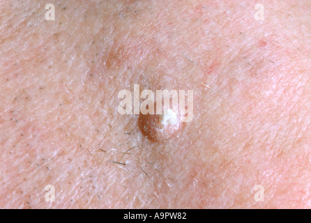KERATOACANTHOMA Stock Photo - Alamy