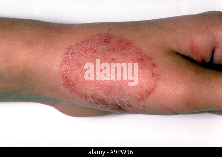 Ringworm fungus infection tinea corporis on young boy's arm Stock Photo ...