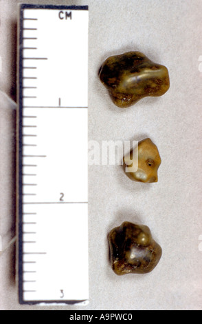 Gall stones, biliary calculi Stock Photo - Alamy