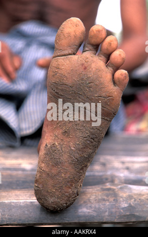 Rural Life – Symptoms of Arsenicosis - ‘Devil’s Water’ ‘Biggest mass ...