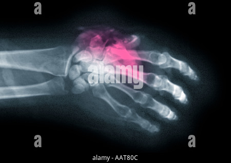gunshot wound to hand with partial amputation of thumb Stock Photo - Alamy