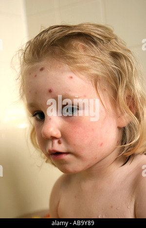 Chickenpox rash. Close-up of a rash on the chest of a 5-year-old male ...