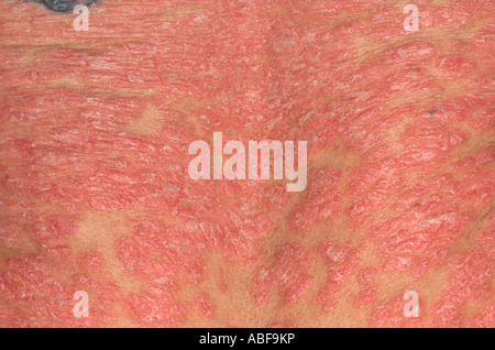Rash of erythrodermic psoriasis (exfoliative psoriatic dermatitis Stock ...