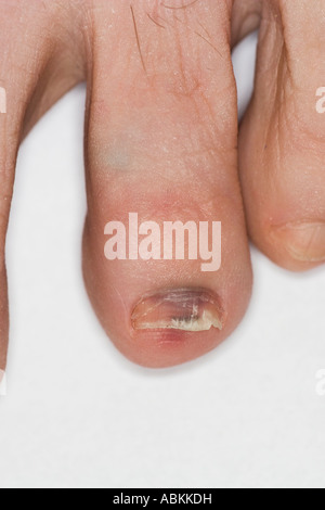 Stubbed toe with bruise and broken nail toenail Stock Photo - Alamy
