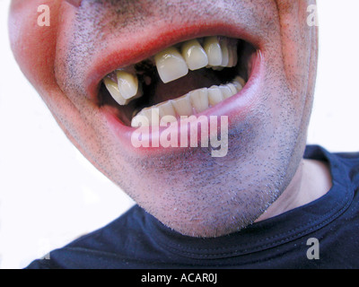 Man with a tooth gap Stock Photo - Alamy